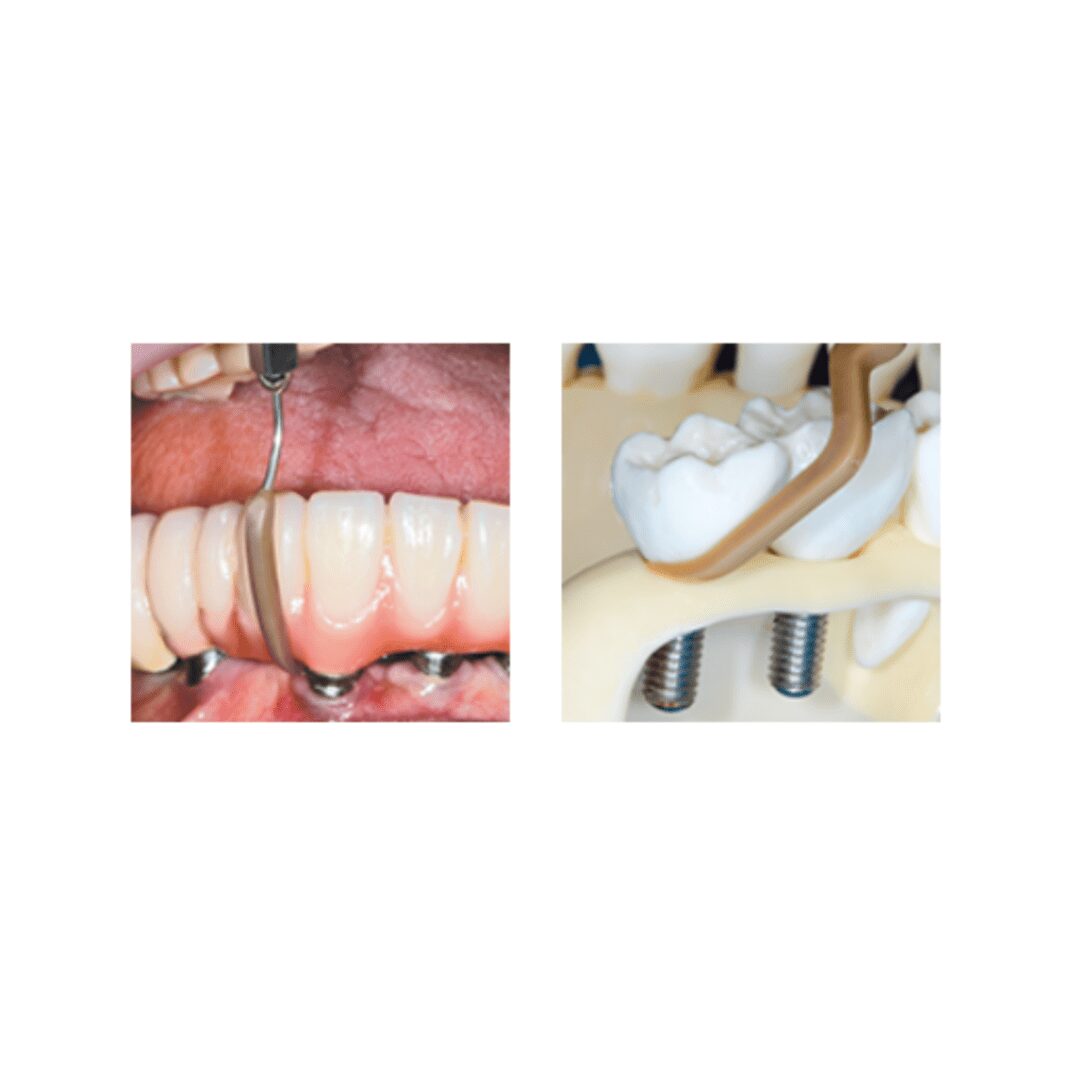 Kit Inserts Maintenance Implantaire - HDO Hightech Dentaire Orléanais