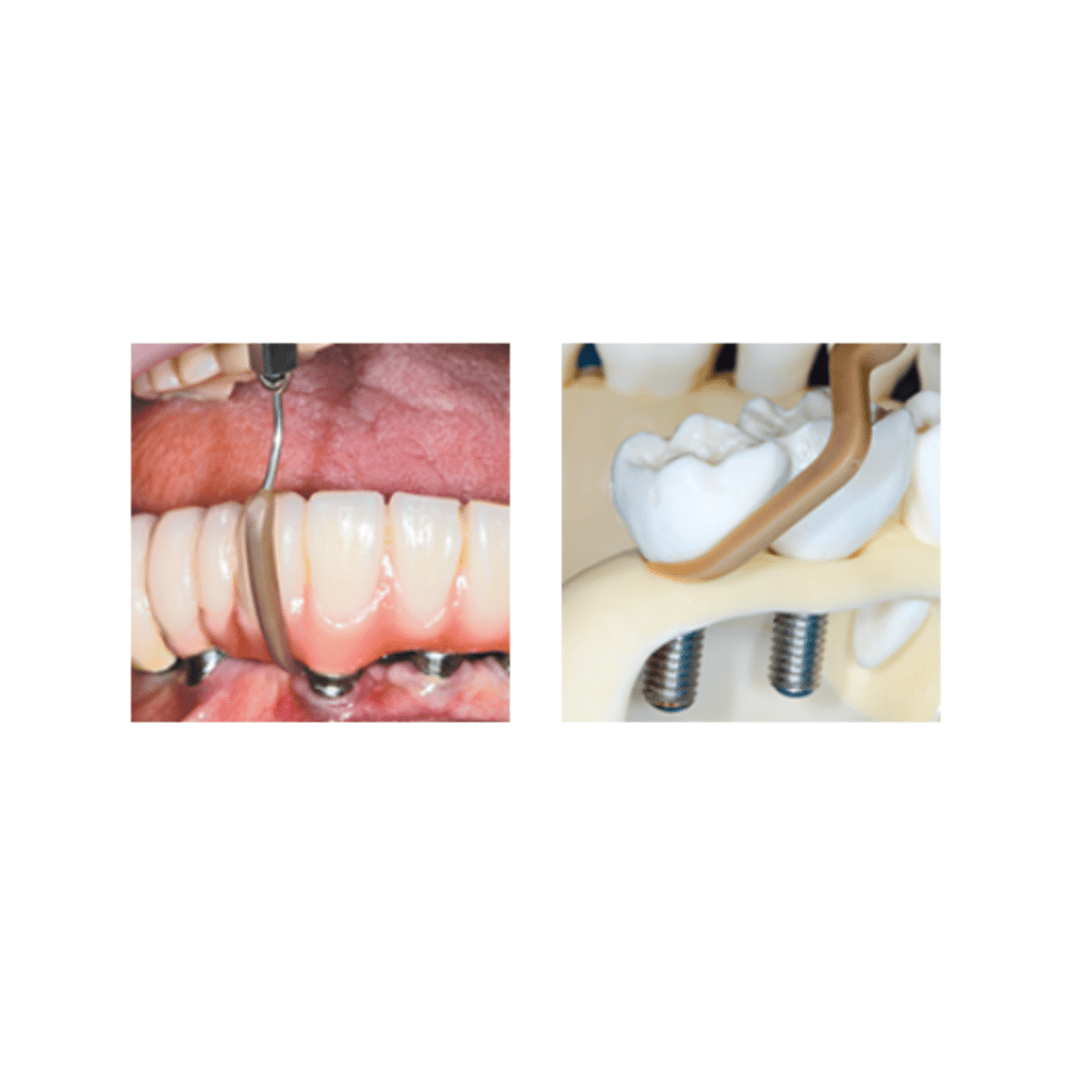 Kit Inserts Maintenance Implantaire - HDO Hightech Dentaire Orléanais